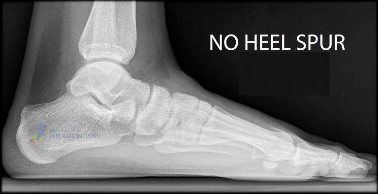 Perth Podiatrist Common Conditions | Heel Spurs & FAQ