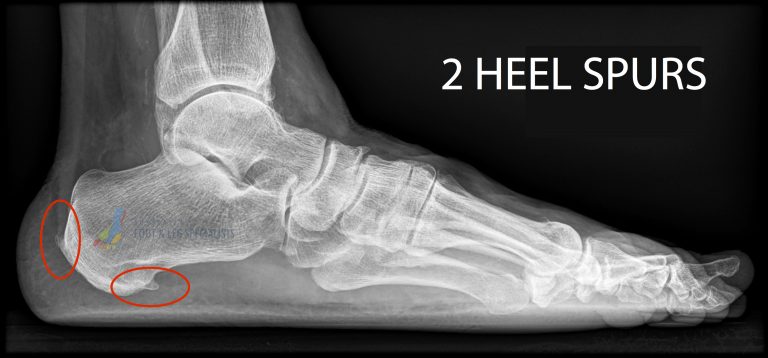 Perth Podiatrist Common Conditions | Heel Spurs & FAQ