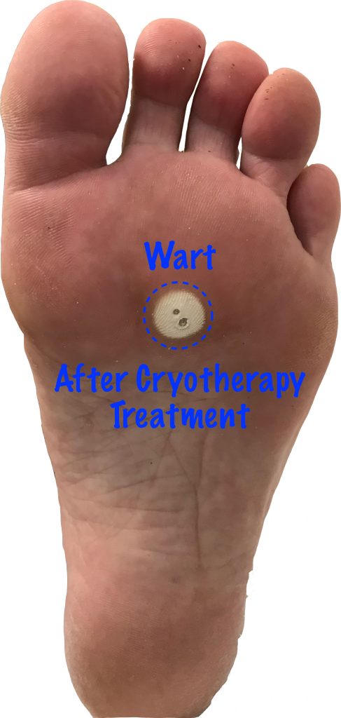 Podiatrist Treatment for Foot Warts or Plantar Verrucae