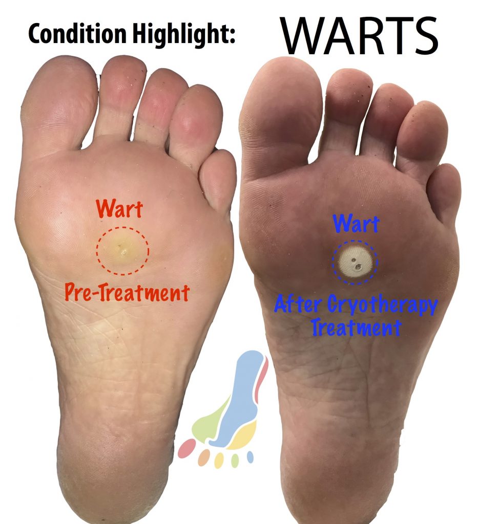 Podiatrist Treatment For Foot Warts Or Plantar Verrucae Podiatrist Treatment For Foot Warts Or Plantar Verrucae